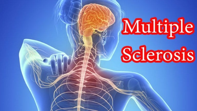 How Multiple Sclerosis Affects Daily Life – Miosuperhealth