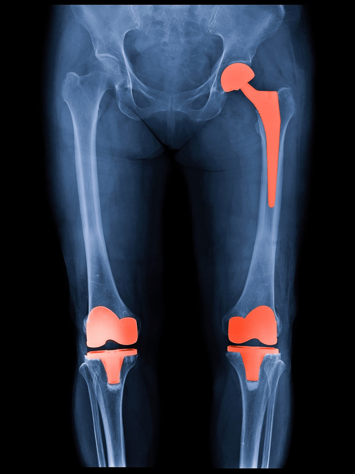 5 Things You Need To Know About Hip Replacements – Miosuperhealth