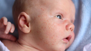 What Are the Most Common Types of Newborn Rashes That Exist Today ...