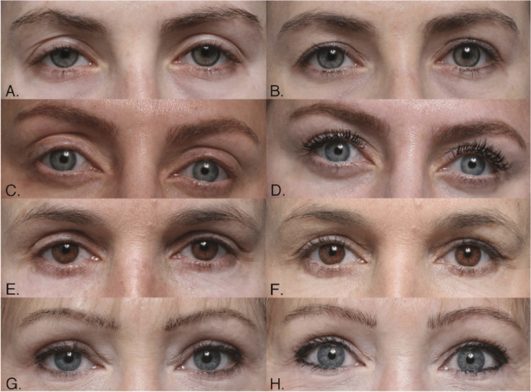 How Do You Know If You Need Ptosis Surgery? – Miosuperhealth